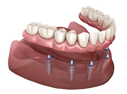 Fixed Dentures on Implants in Toronto